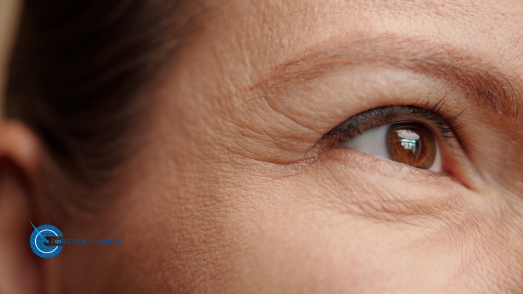 Crow’s Feet Botox (Eye Wrinkles) - Forever Clinica