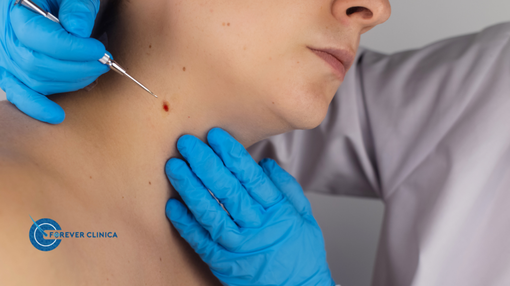 What is Nevus Excision? Nevus Excision Treatment - Forever Clinica